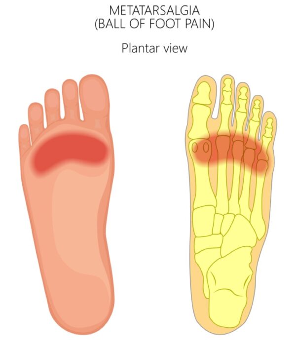 Metatarsalgia - how Orthotics help? - Ease The Feet